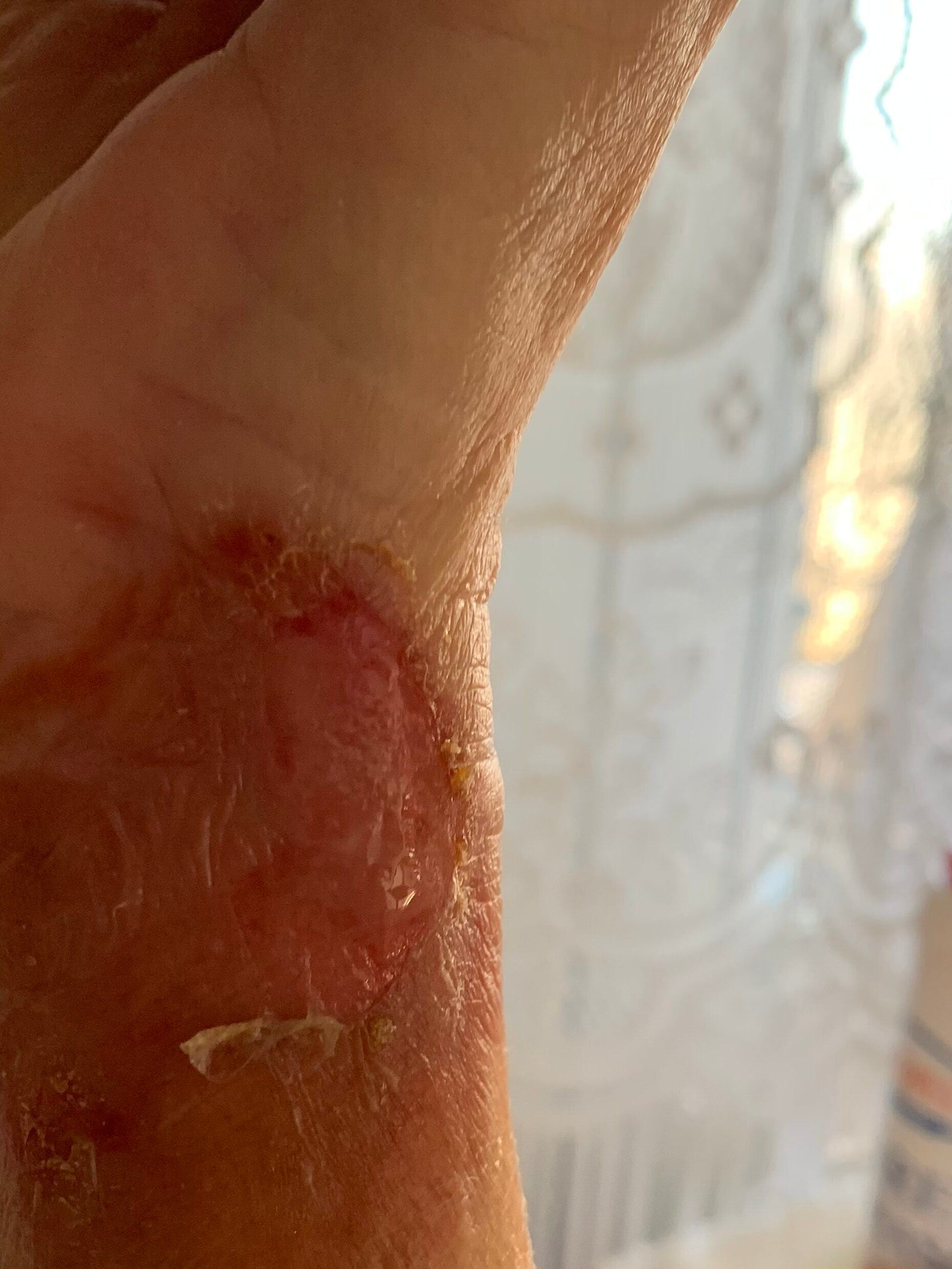 Burn Rehabilitation – HealDerm