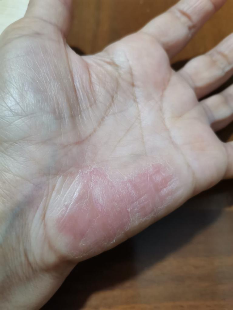 Psoriasis – HealDerm